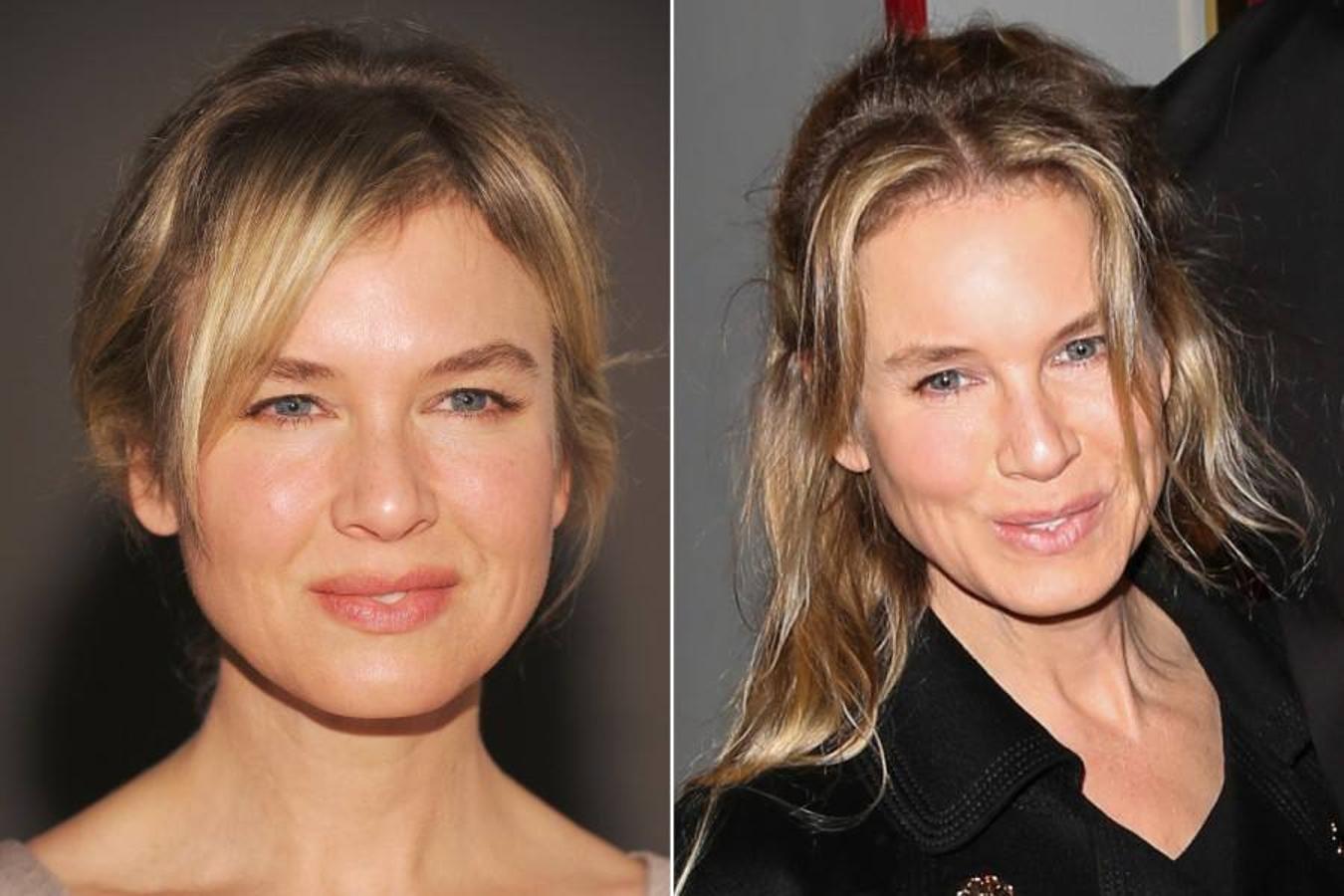 Celebrities transformados por el botox