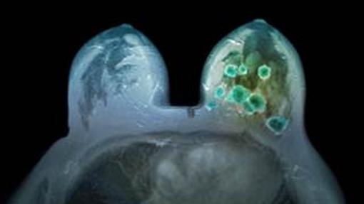 Todo lo que tienes que saber sobre el cáncer de mama